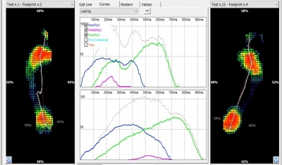 Plantar Pressure Analysis & Diagnosis - Stepforce