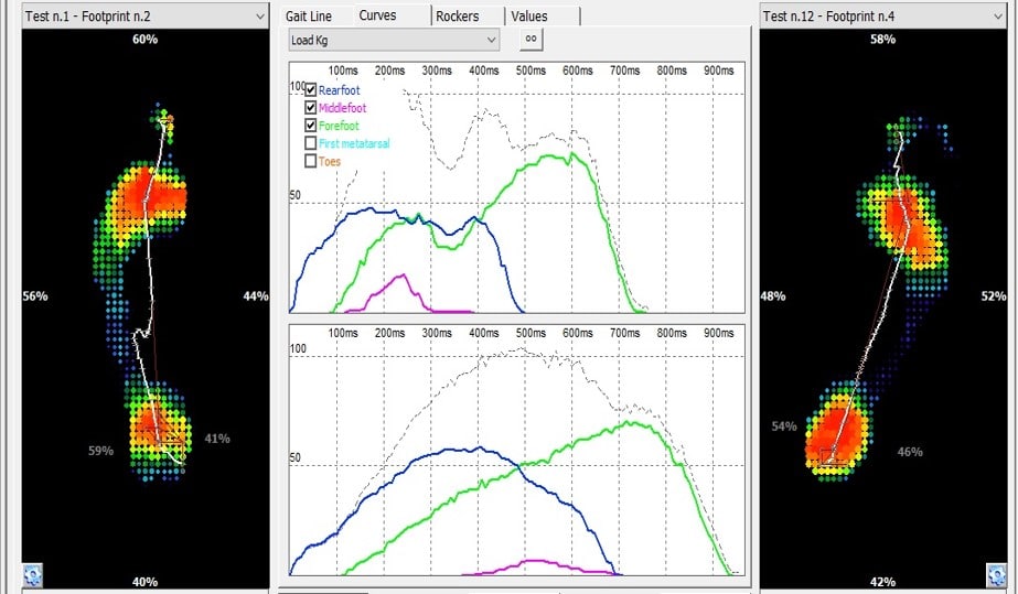 Plantar Pressure Analysis & Diagnosis - Stepforce